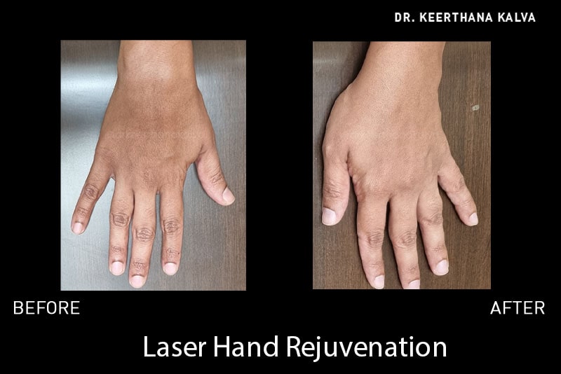 Real Results | Before and After Treatment Photos | Dr. Keerthana Kalva